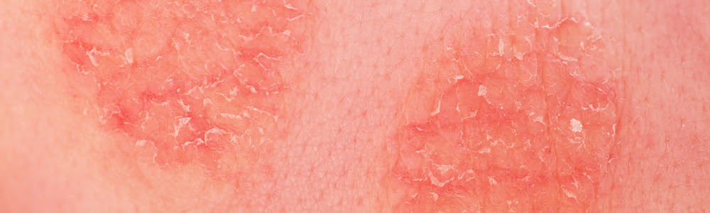 HIV Rash: Is my rash a symptom of HIV or something else?