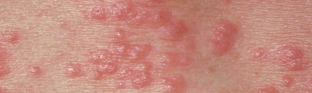 Skin Rash And Sexually Transmitted Diseases: Symptoms,, 43% OFF