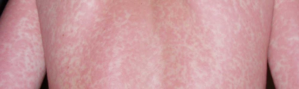 Hiv Seroconversion Rash Arms