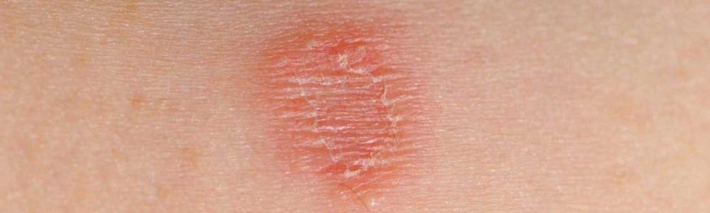 HIV Rash: Is my rash a symptom of HIV or something else?