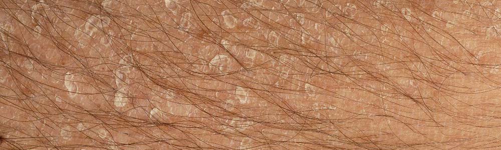 Hiv Rash On Chest Black People