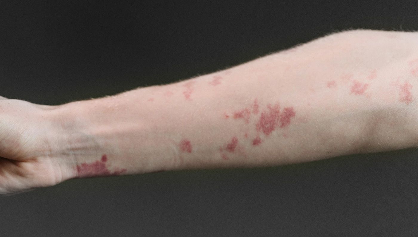 Hiv Rashes Look Like Infoupdate