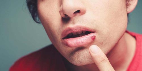 Incubation Periods of STDs