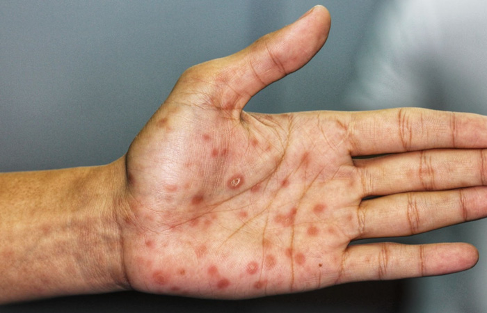 Understanding HIV Rash: Symptoms, Treatment, and Identification