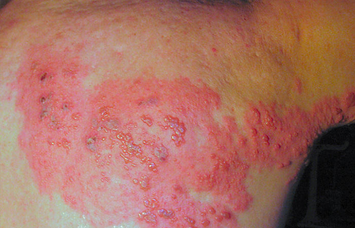 Understanding HIV Rash: Symptoms, Treatment, and Identification