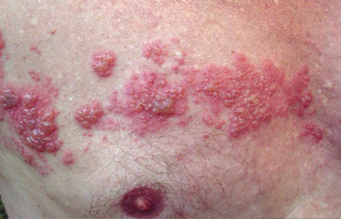 Understanding HIV Rash: Symptoms, Treatment, and Identification